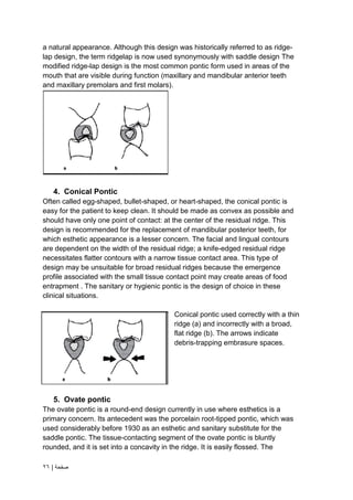 Bridge and Pontic Design .pdf