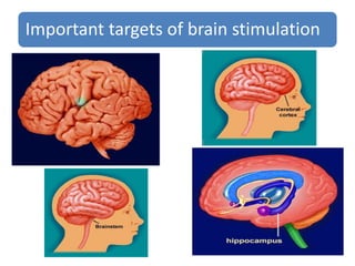 Brief overview of brain stimulation techniques | PPTX
