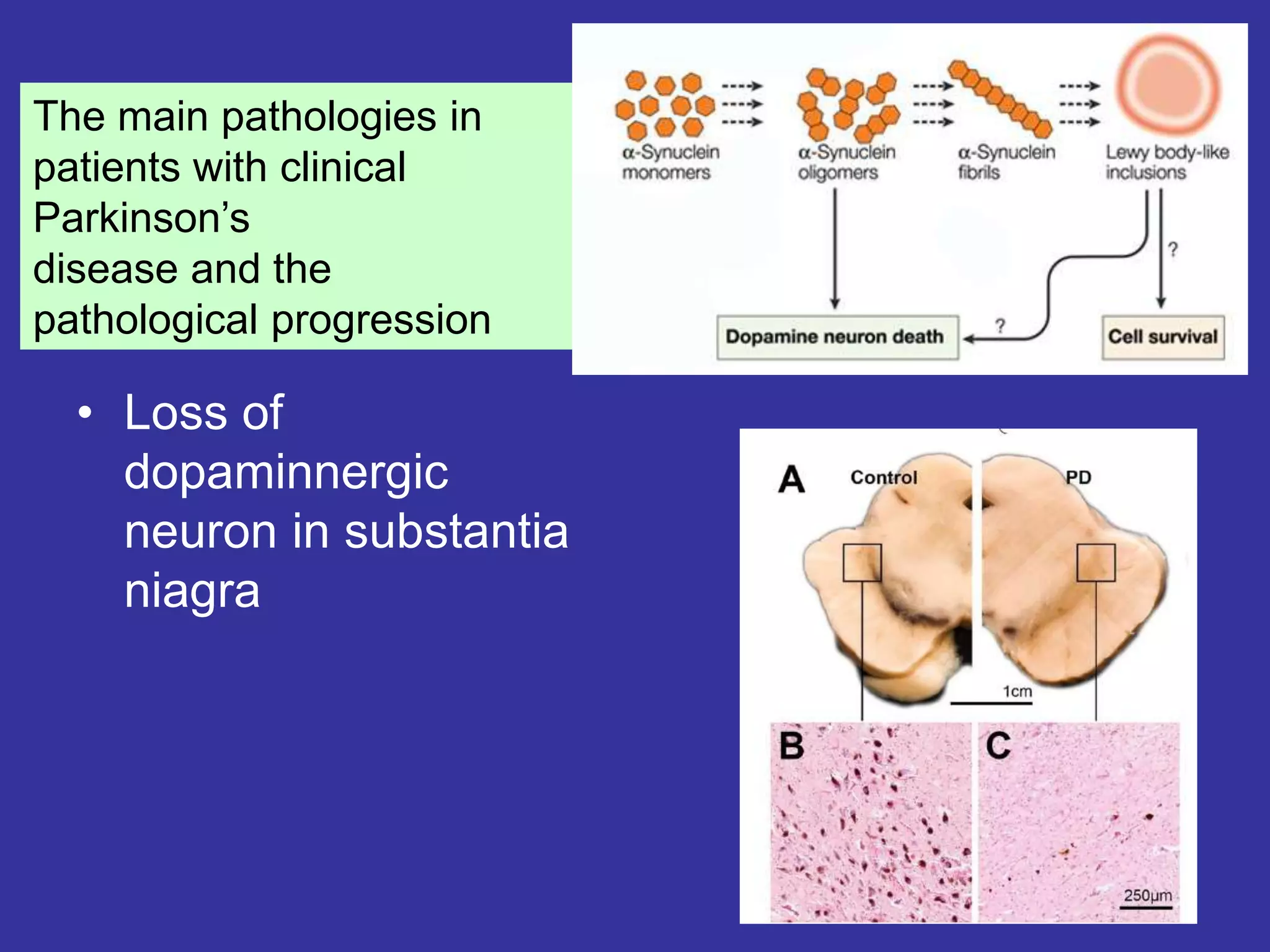 Brief overview of hypokinetic movement disorder | PPT