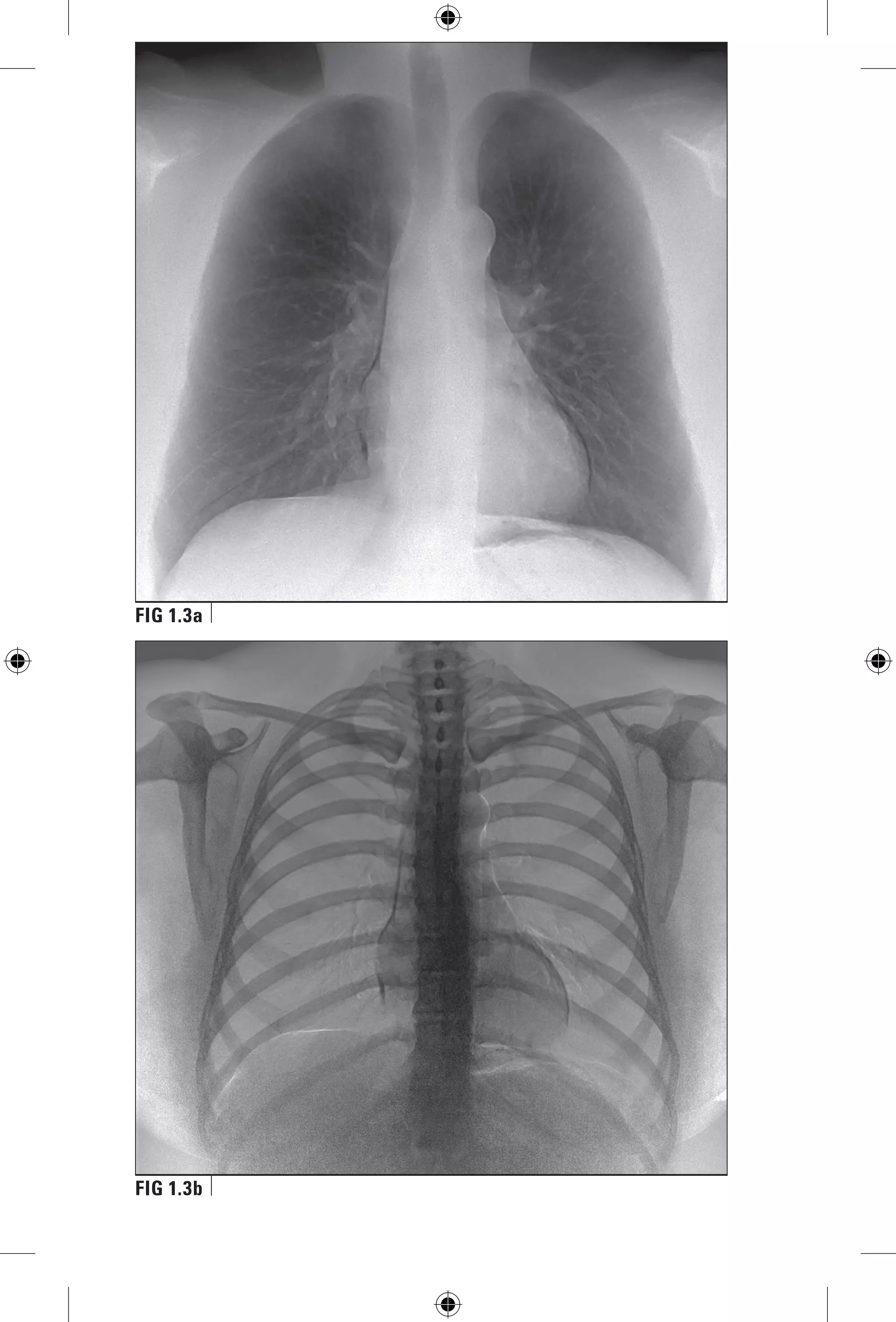 Pocket Guide to Chest X-Rays - sample chapter | PDF
