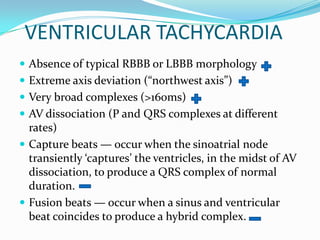 Broad complex tachycardia | PPT
