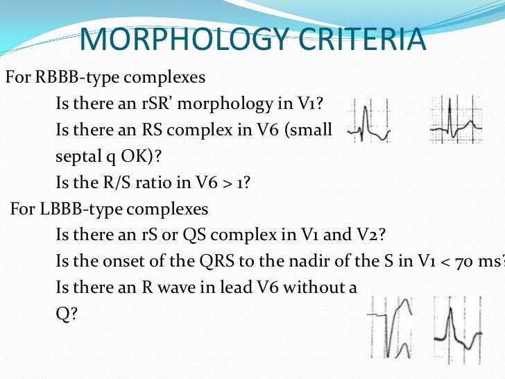 Broad complex tachycardia