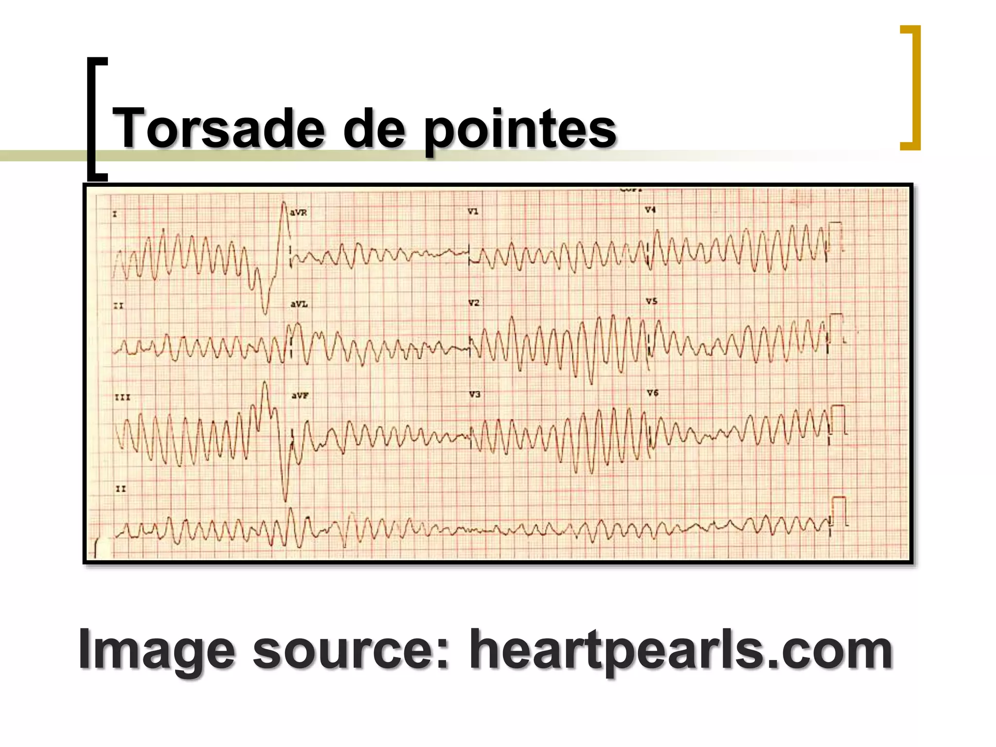 Broad complex tachycardia | PPSX