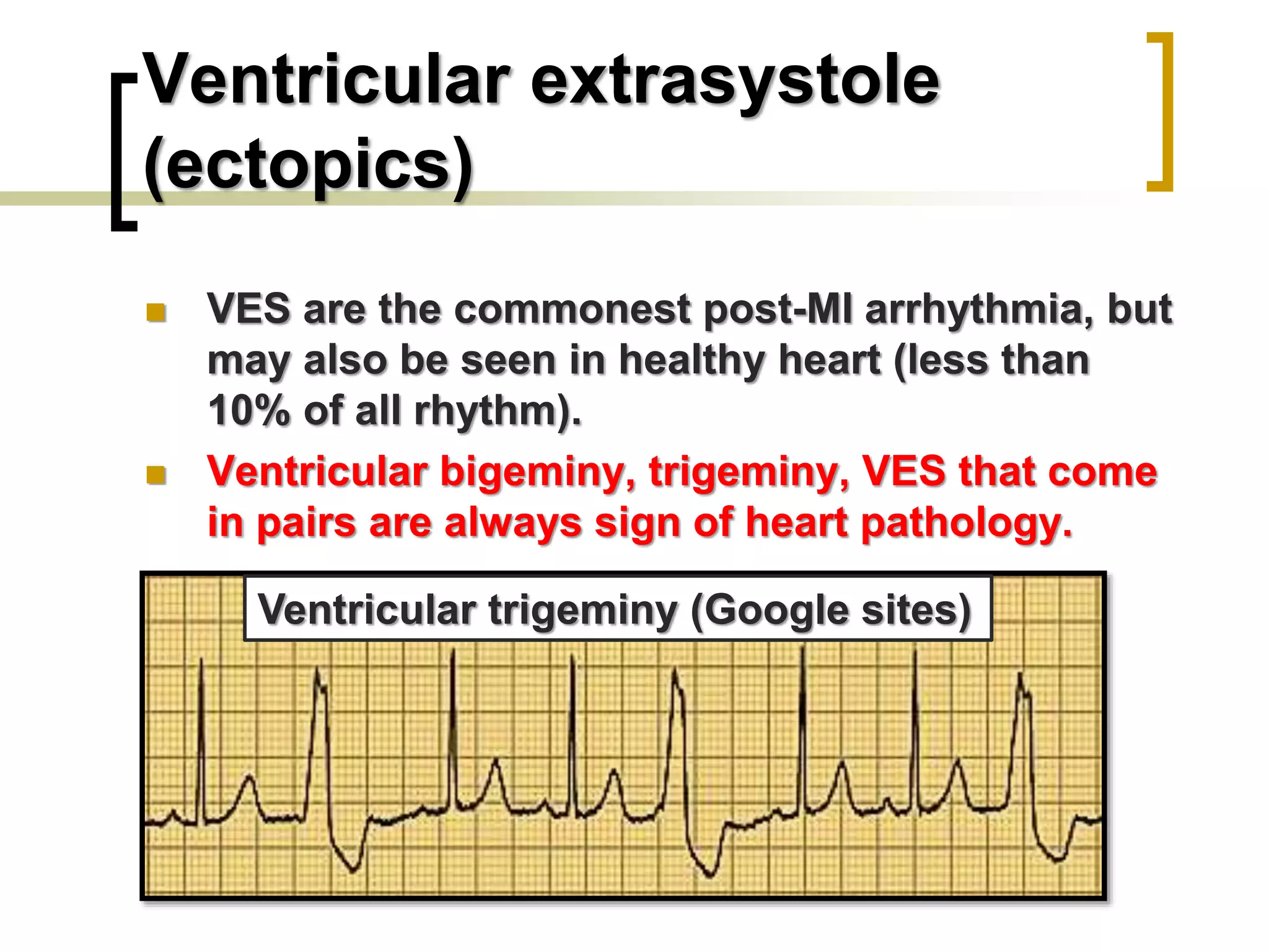 Broad complex tachycardia | PPSX