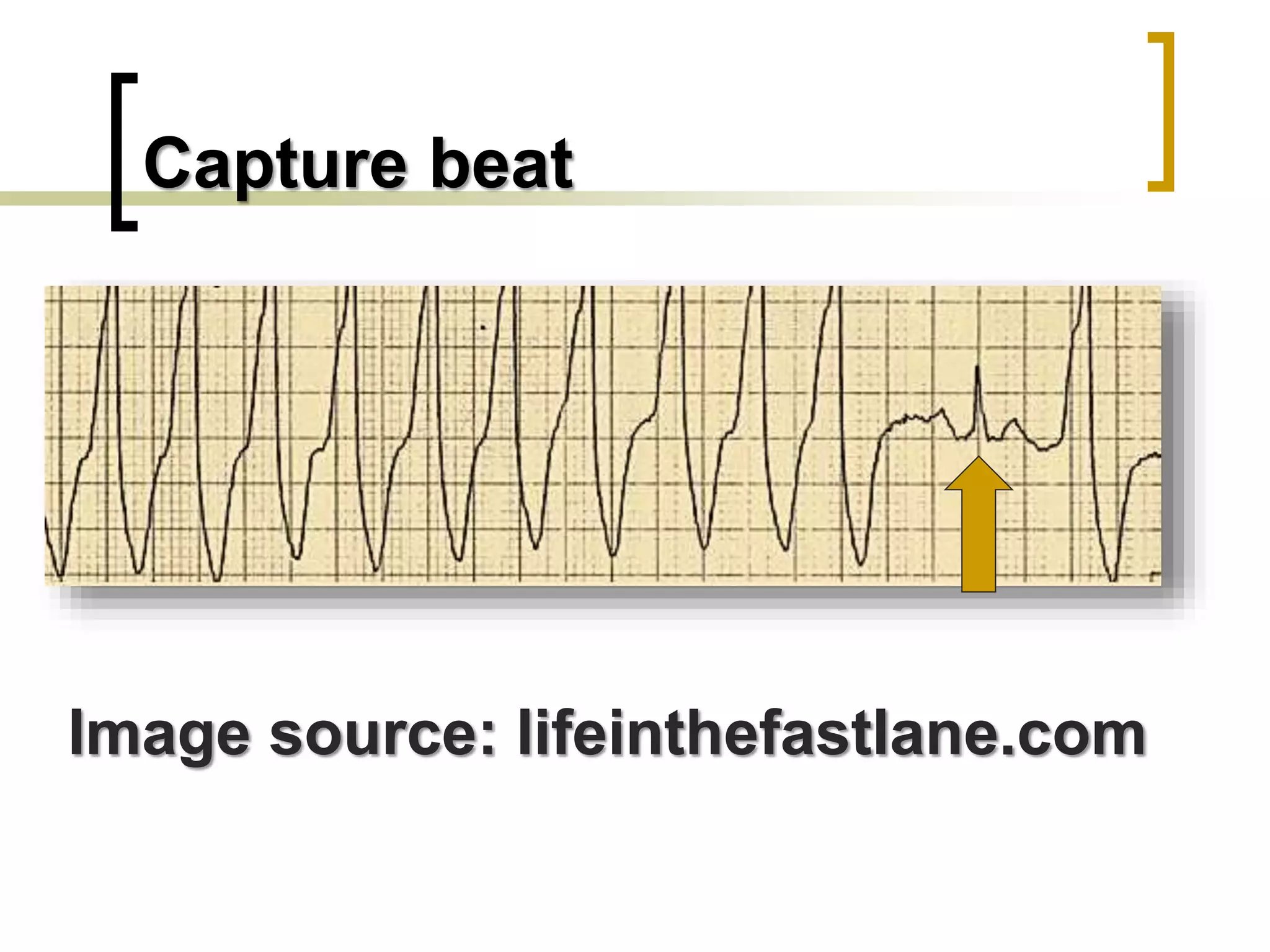 Broad complex tachycardia | PPSX