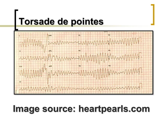 Broad complex tachycardia | PPT