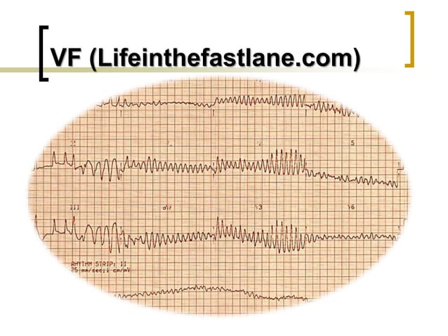Broad complex tachycardia | PPT