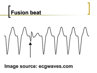 Broad complex tachycardia | PPT