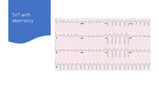 BROAD COMPLEX TACHYCARDIA in emergency.pptx