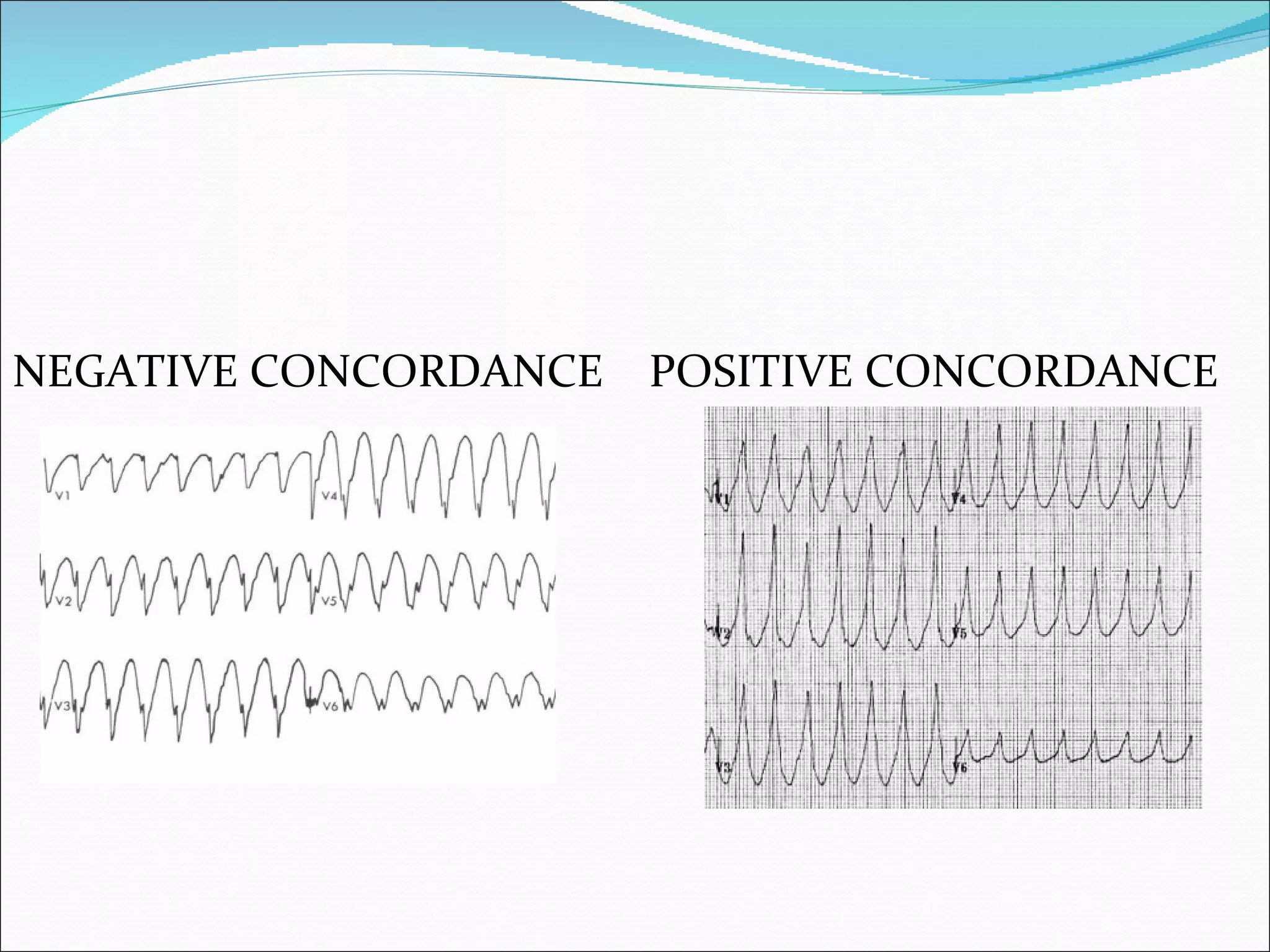 ECG: Wide Complex Tachycardia | PPT