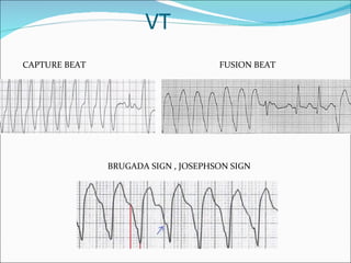 ECG: Wide Complex Tachycardia | PPT
