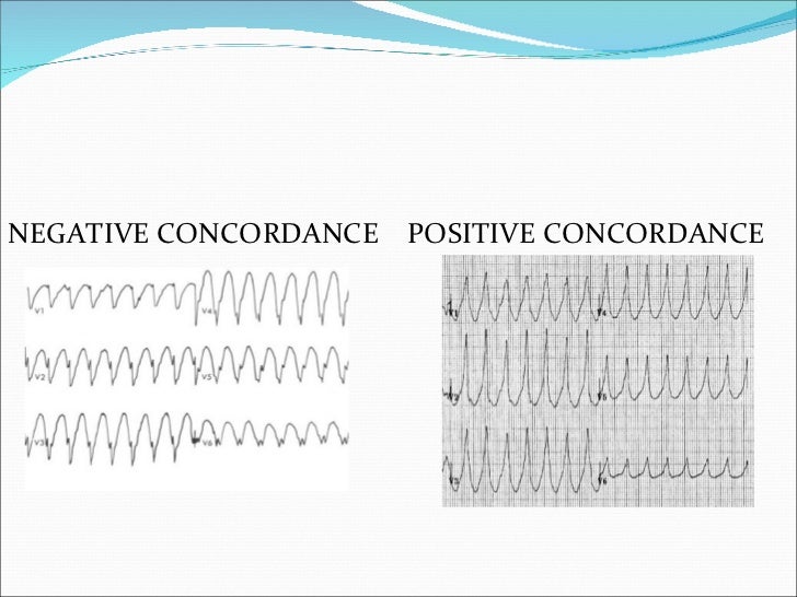 ECG: Wide Complex Tachycardia
