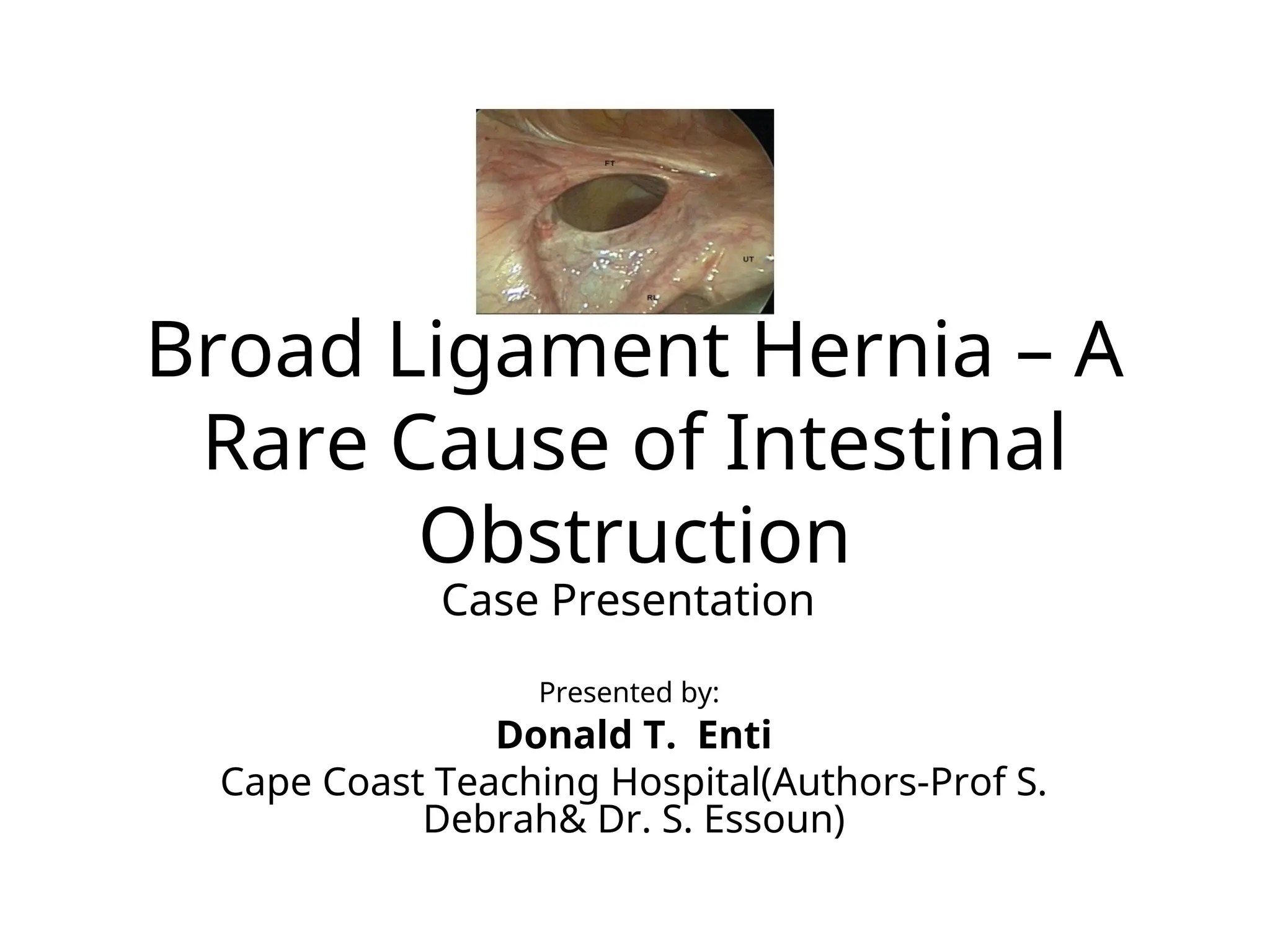 Broad Ligament Hernia.ppt for medical doctors | PPT