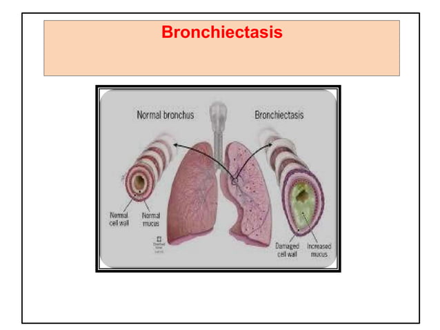 CHAPTER-IV RESPIRATORY SYSTEM Brochiectasis - .ppt