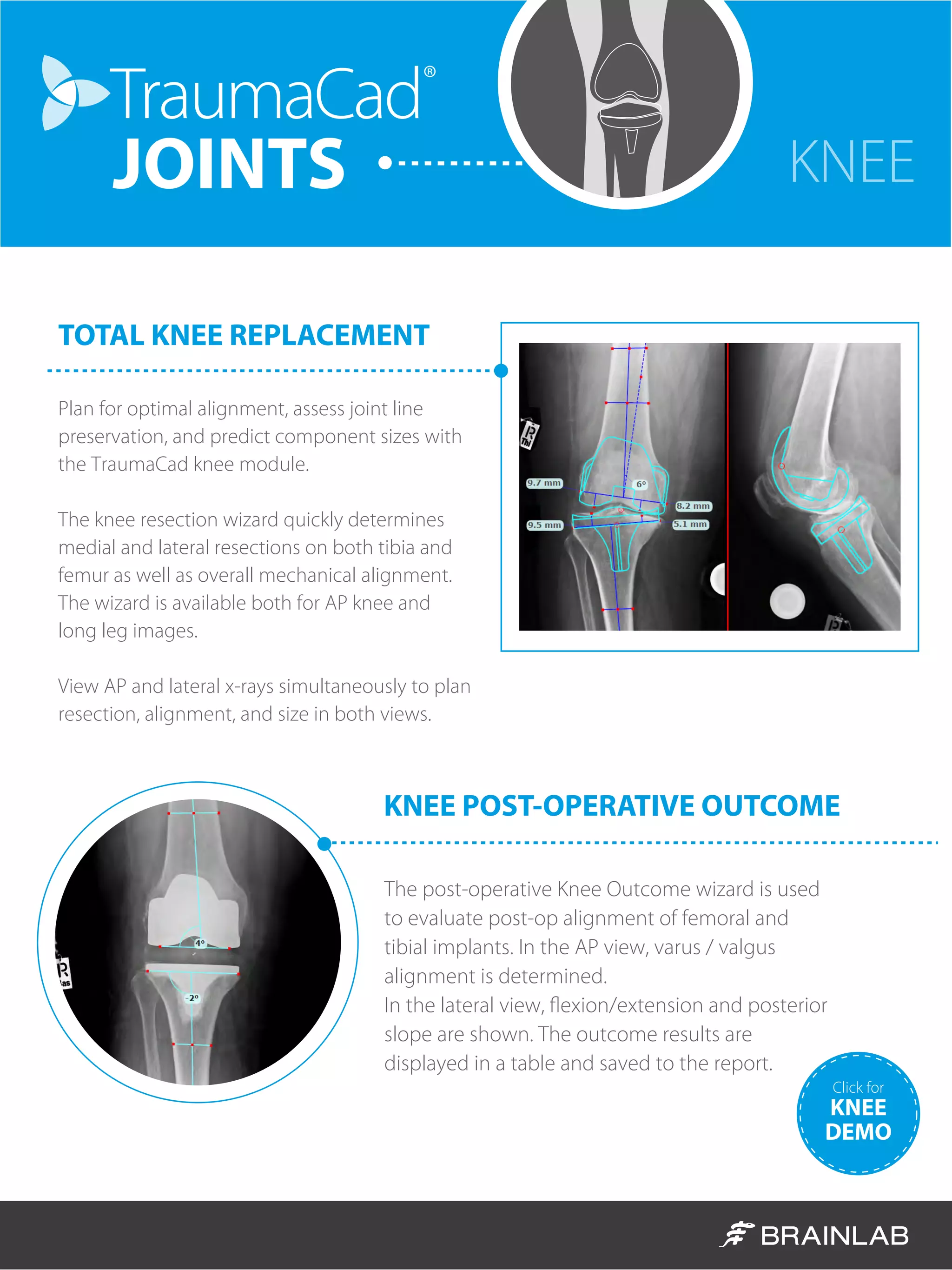 Brochure TraumaCad 2.4 Joints | PDF