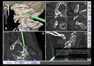 Image-Guided Spine Navigation Brochure | PDF