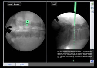 Image-Guided Spine Navigation Brochure | PDF