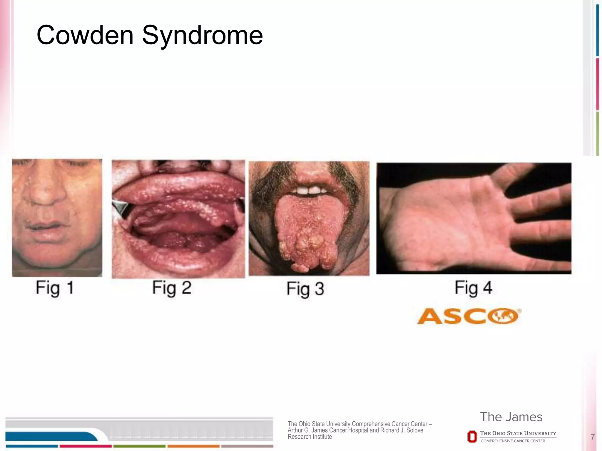 Genetic Syndromes and Thyroid Cancer by Pamela Brock, MS, LGC | PPTX