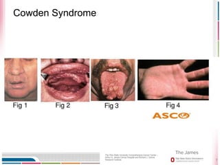 Genetic Syndromes and Thyroid Cancer by Pamela Brock, MS, LGC | PPTX ...