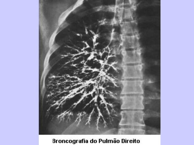 Broncografia | PPT