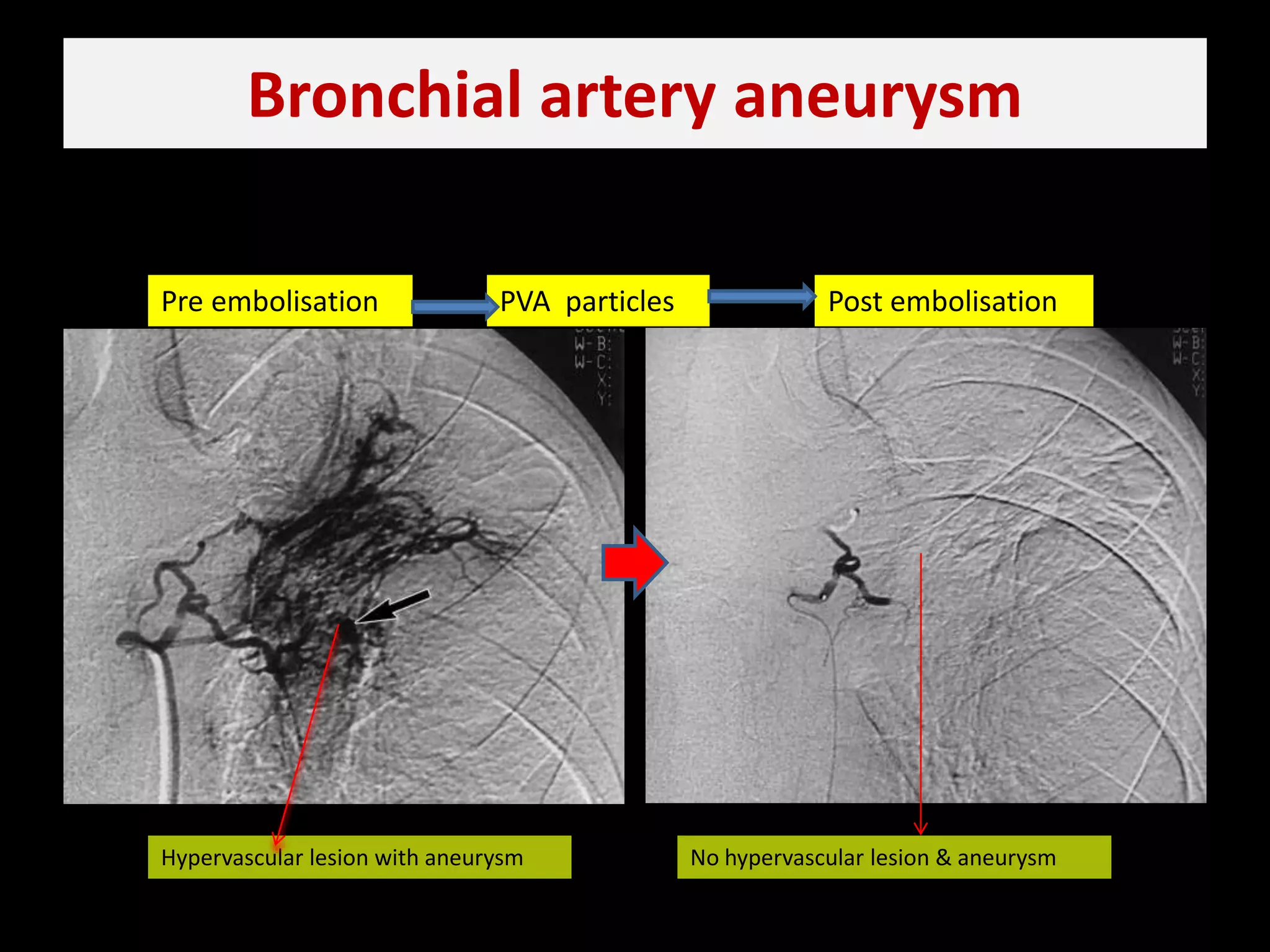 Bronchial Artery Embolization- By Dr.Tinku Joseph | PPTX