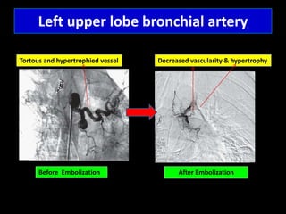 Bronchial Artery Embolization