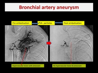 Bronchial Artery Embolization