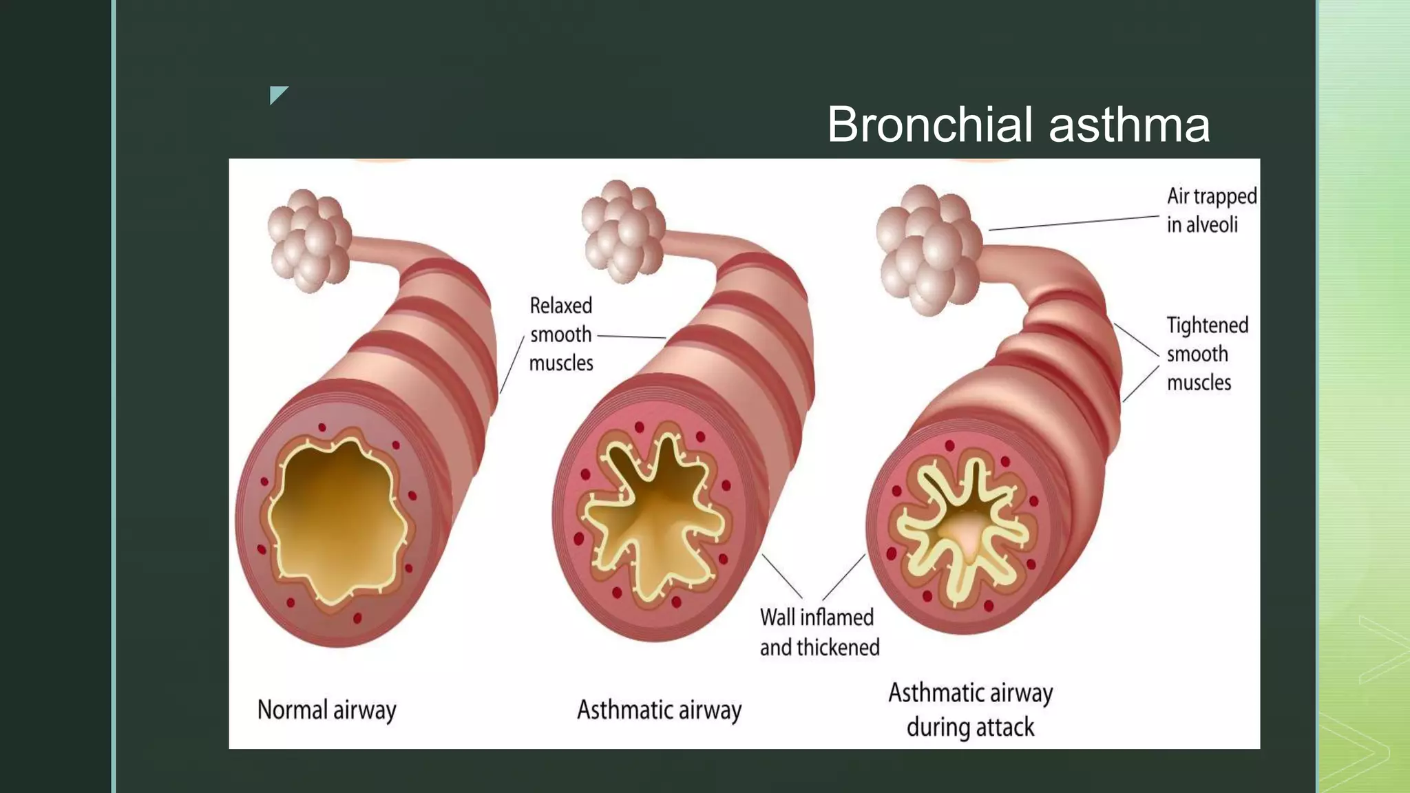Bronchial asthma | PPTX