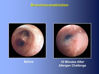Bronchial asthma | PPT
