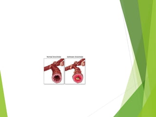 Bronchial asthma | PPT