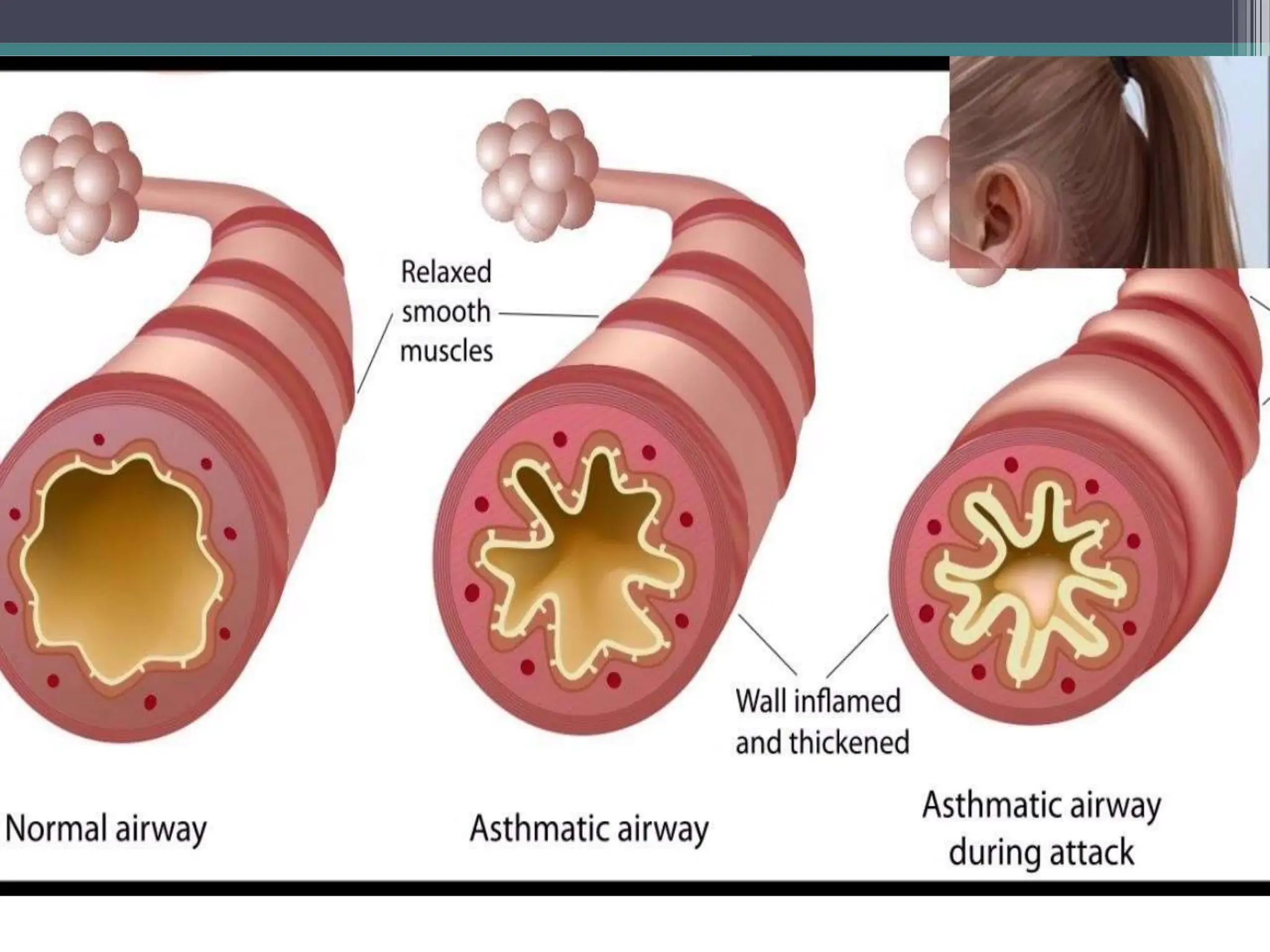Airways obstruction (Bronchial Asthma).pptx