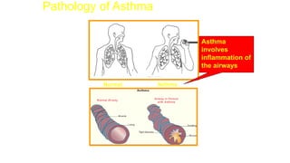 BRONCHIAL ASTHMA explaining the pathogenesis and clinical fatures | PDF