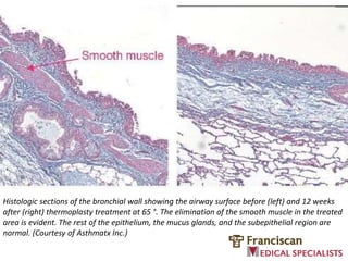 Bronchial Thermoplasty (BT) Novel Treatment for Patients with Severe ...