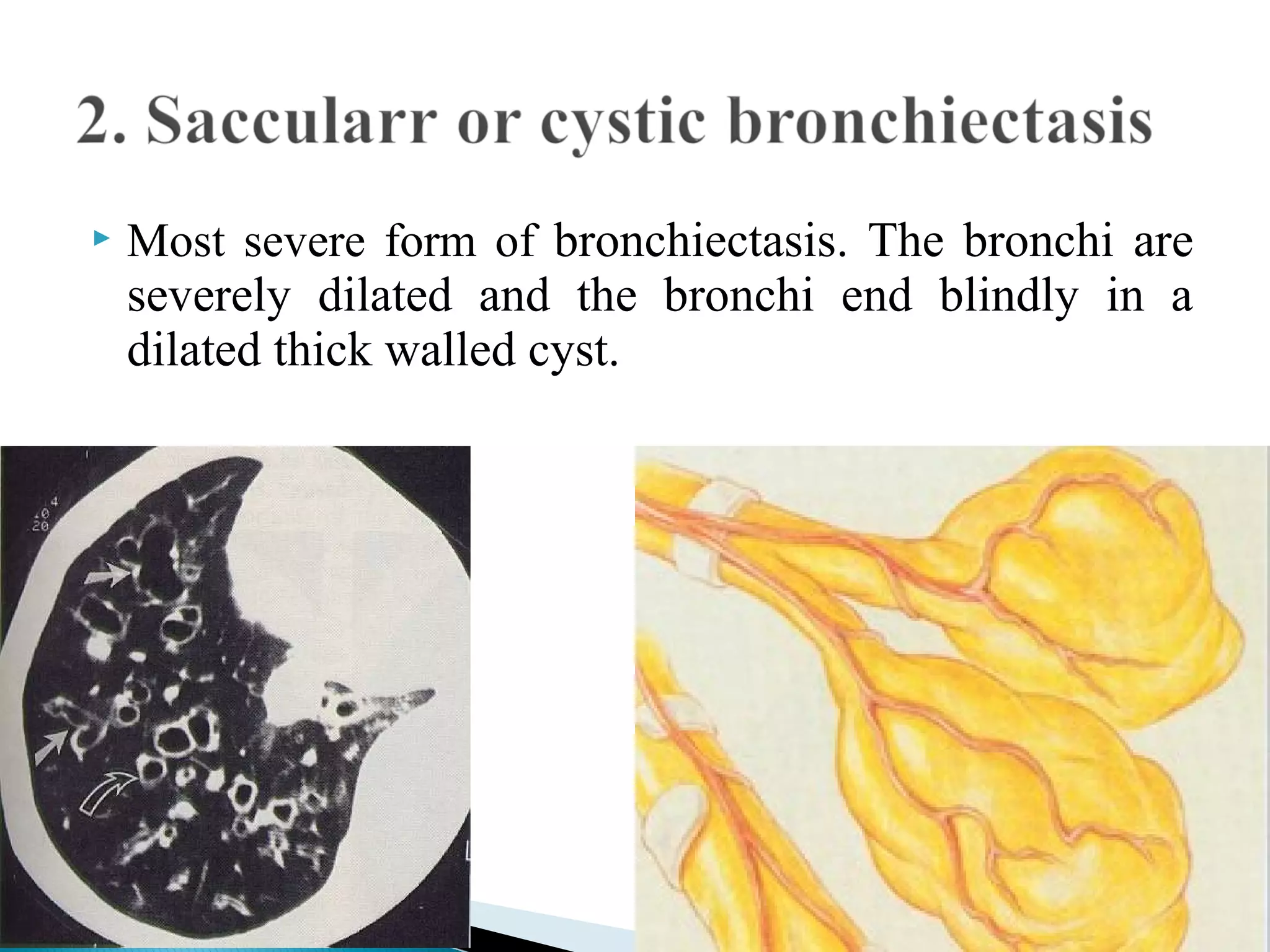Bronchiectases | PPT