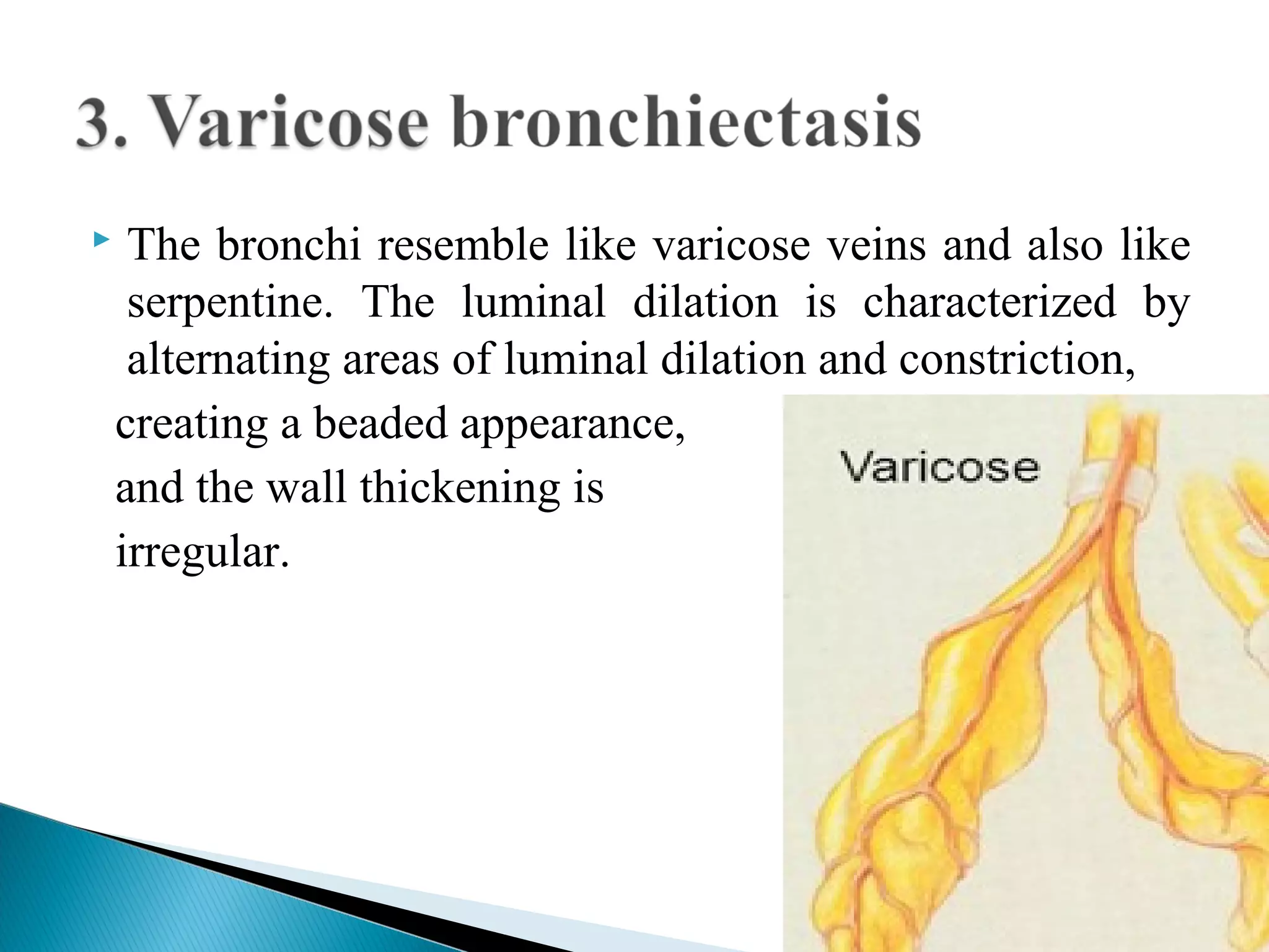 Bronchiectases | PPT