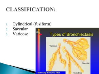 Types Of Bronchiectasis