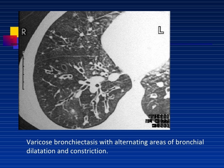 Bronchiectasis