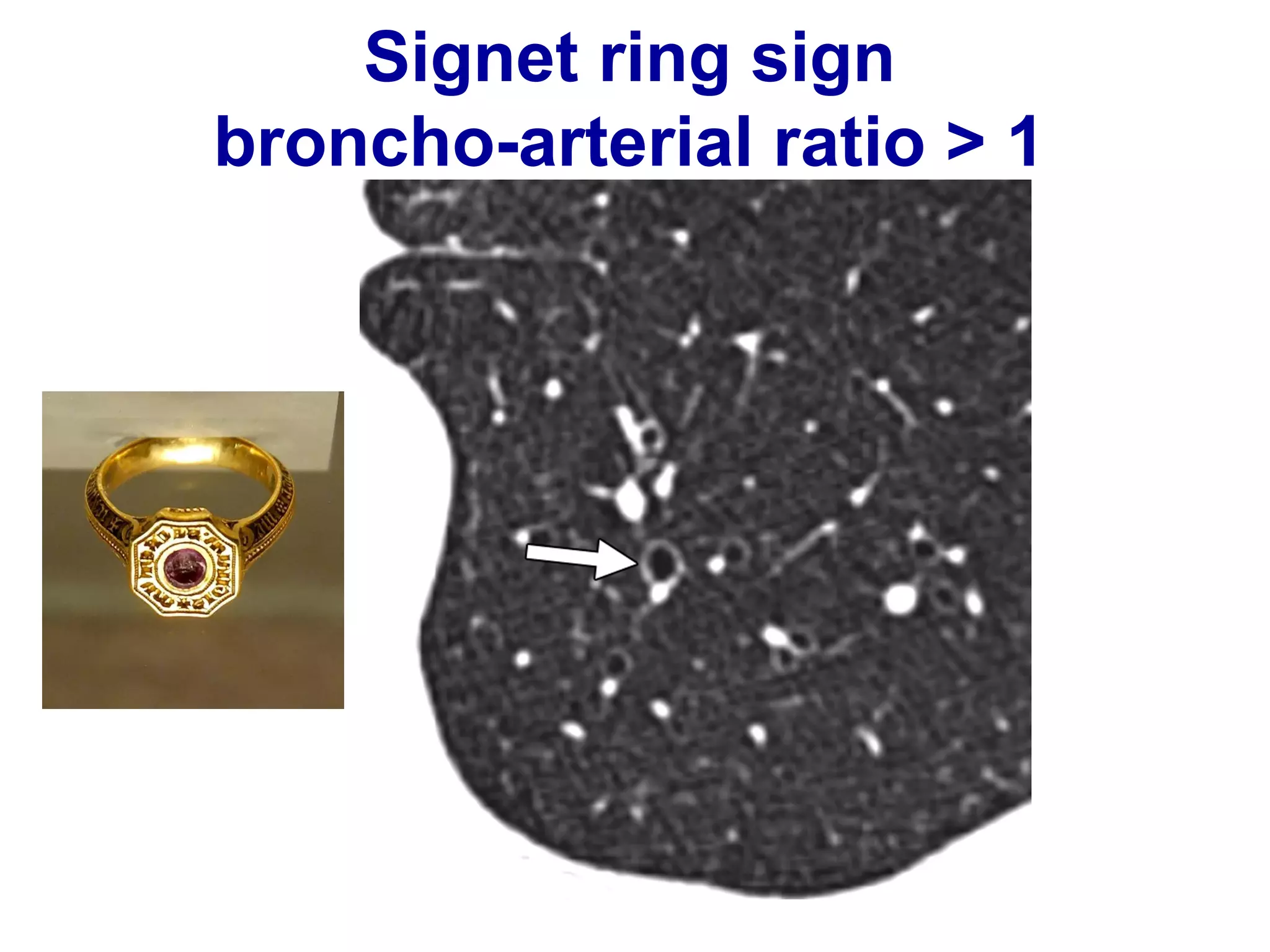 Bronchiectasis | PPT