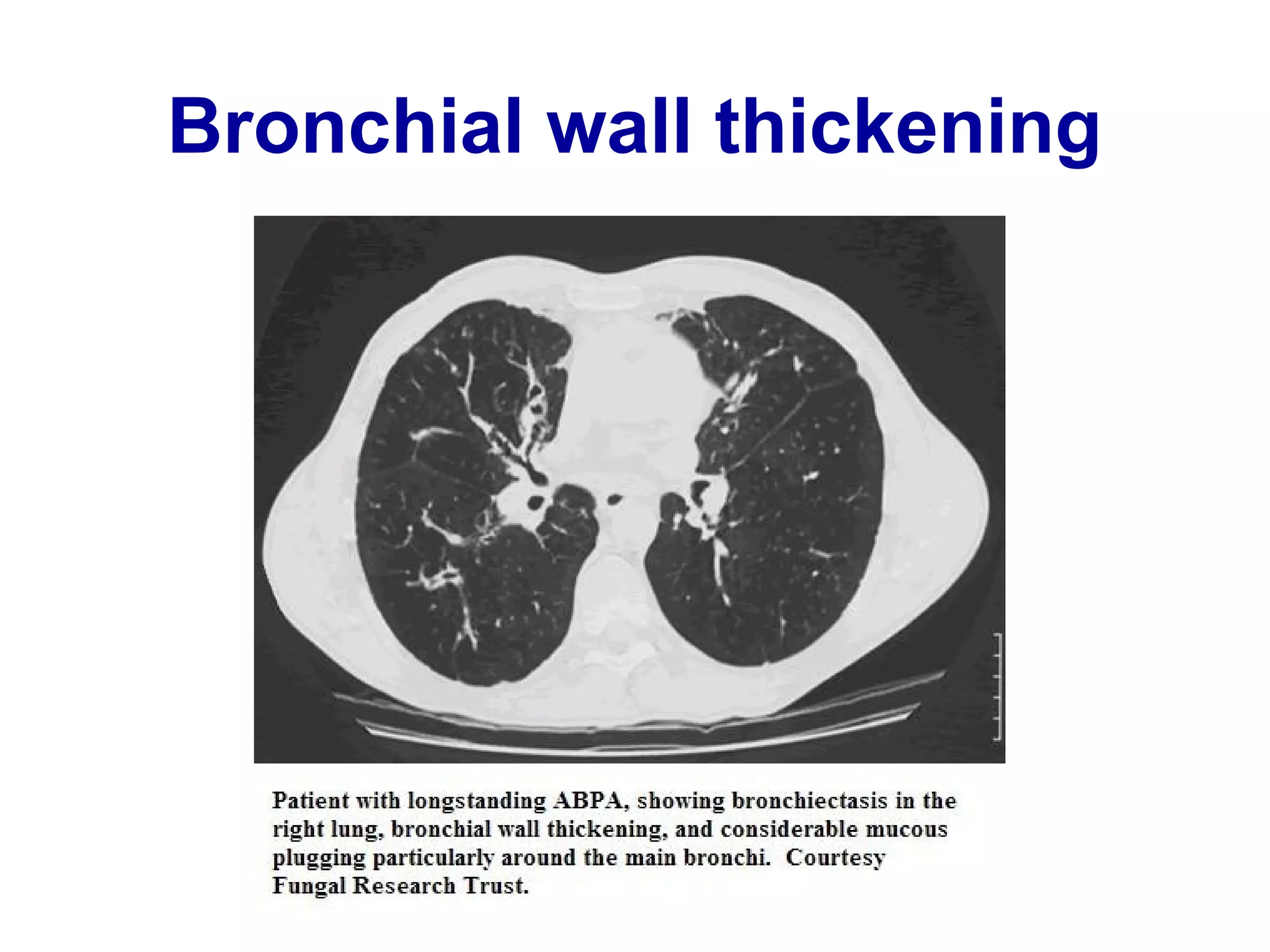 Bronchiectasis | PPT
