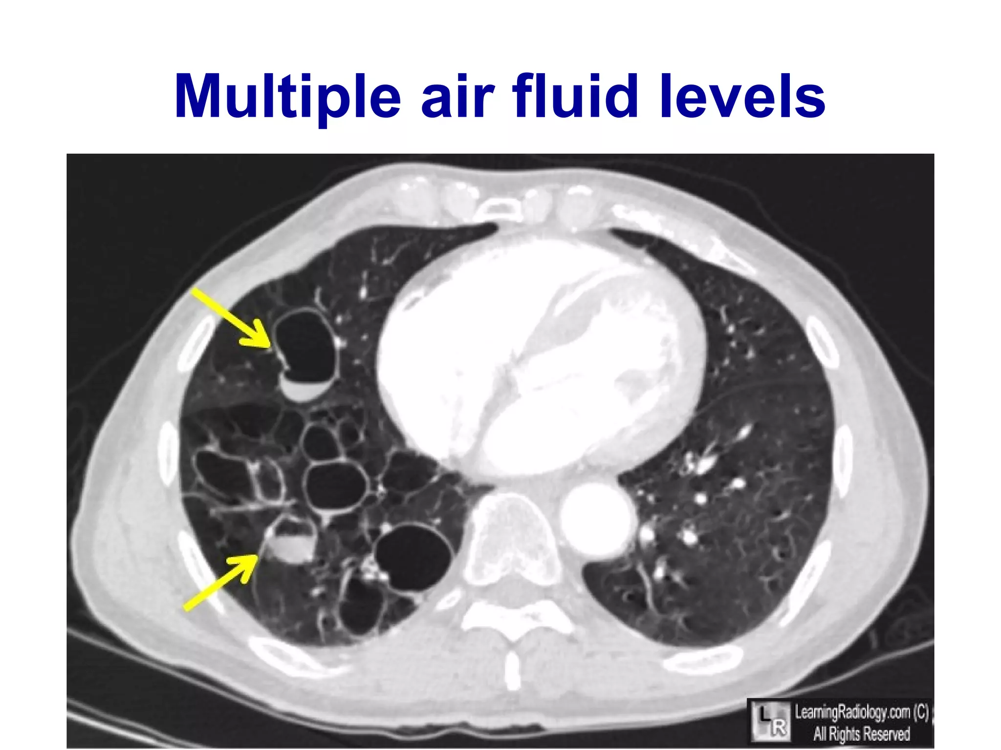 Bronchiectasis | PPT