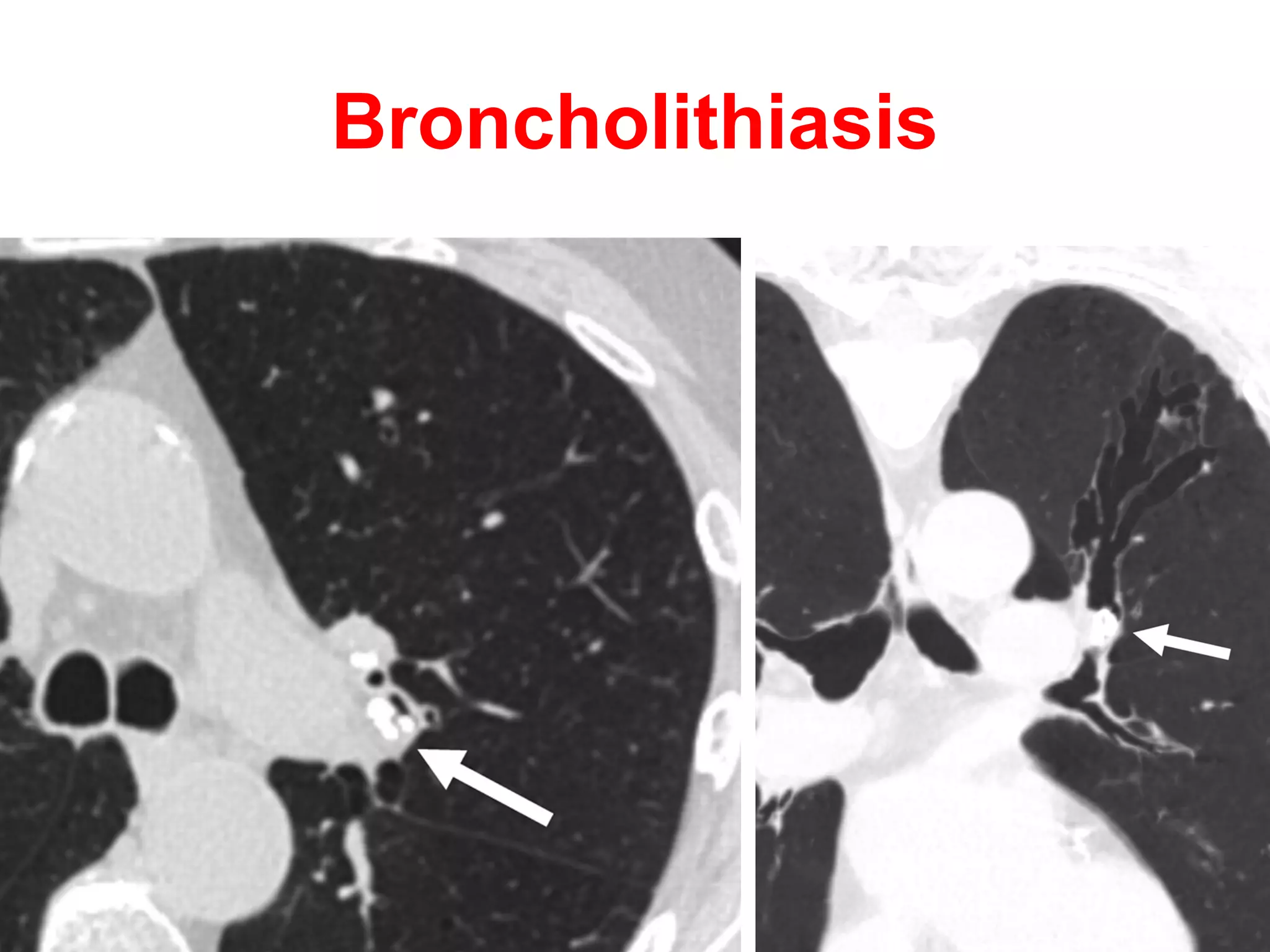Bronchiectasis | PPT