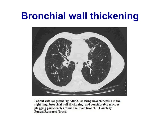 Bronchiectasis | PPT | Lung and Respiratory Health | Diseases and ...