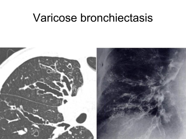 Bronchiectasis | PPT | Lung and Respiratory Health | Diseases and ...