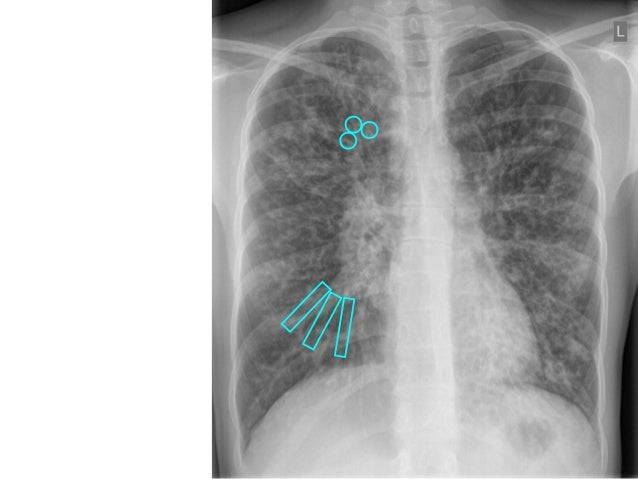 Bronchiectasis Tram Track