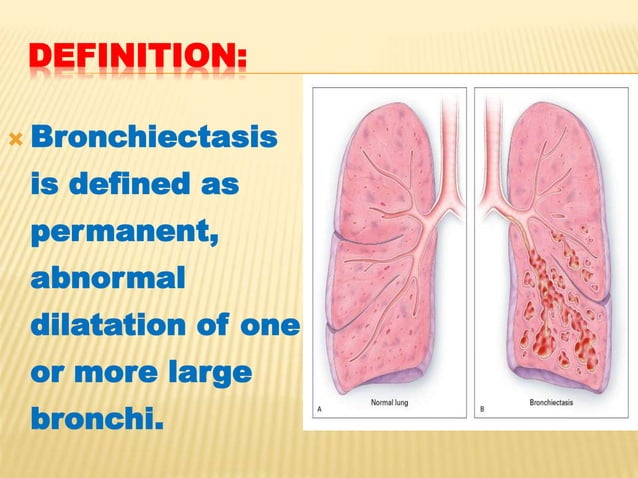 Bronchiectasis | PPTX
