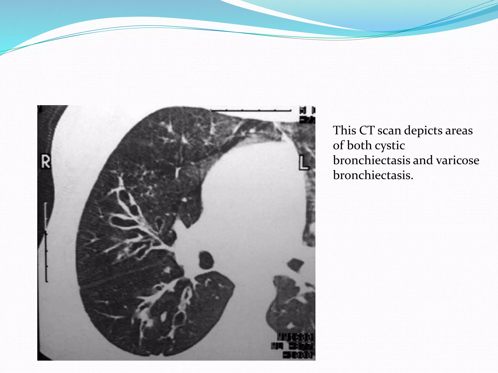 Bronchiectasis | PPTX
