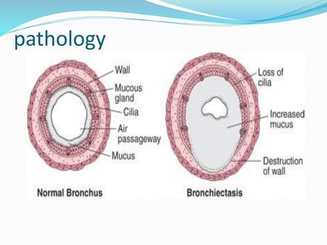 Bronchiectasis | PPTX | Lung and Respiratory Health | Diseases and ...