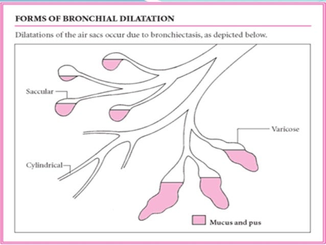 Bronchiectasis.