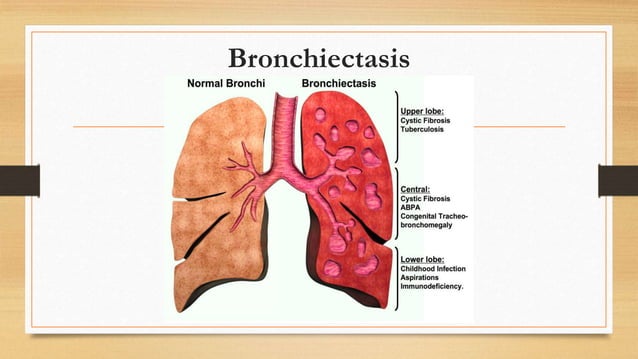 Bronchiectasis | PPTX | Lung and Respiratory Health | Diseases and ...
