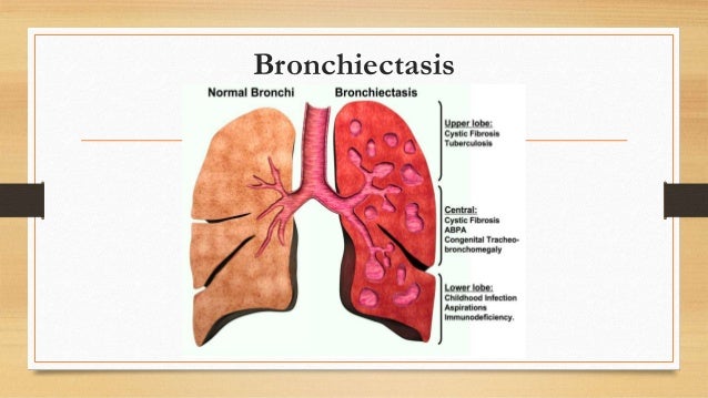 Bronchiectasis